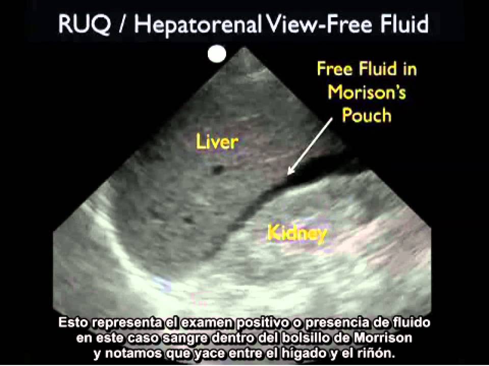 Procedimiento para realizar un examen FAST del cuadrante superior ...