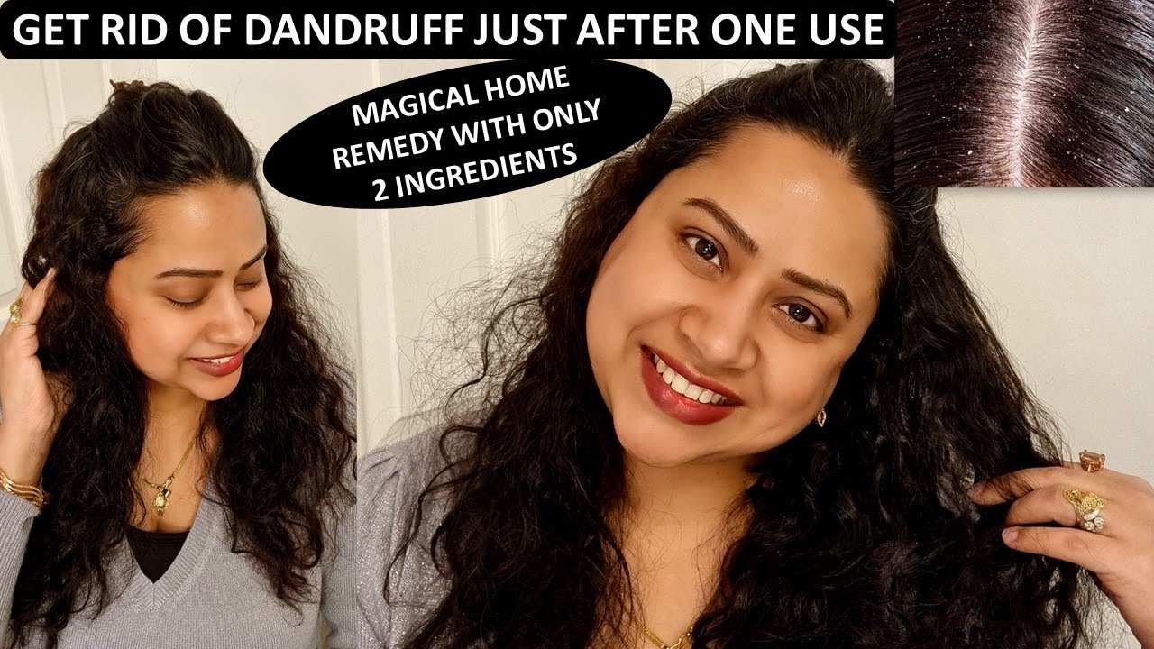 Anti Dandruff Home Remedy | How To Get Rid Of Itchy Flaky Dandruff ...