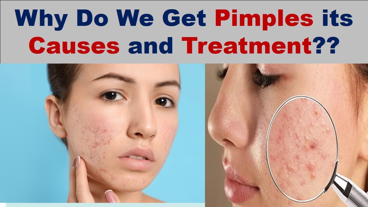 How Do We Get Pimples and its Treatment | Creative Thinkers Sid Voice ...