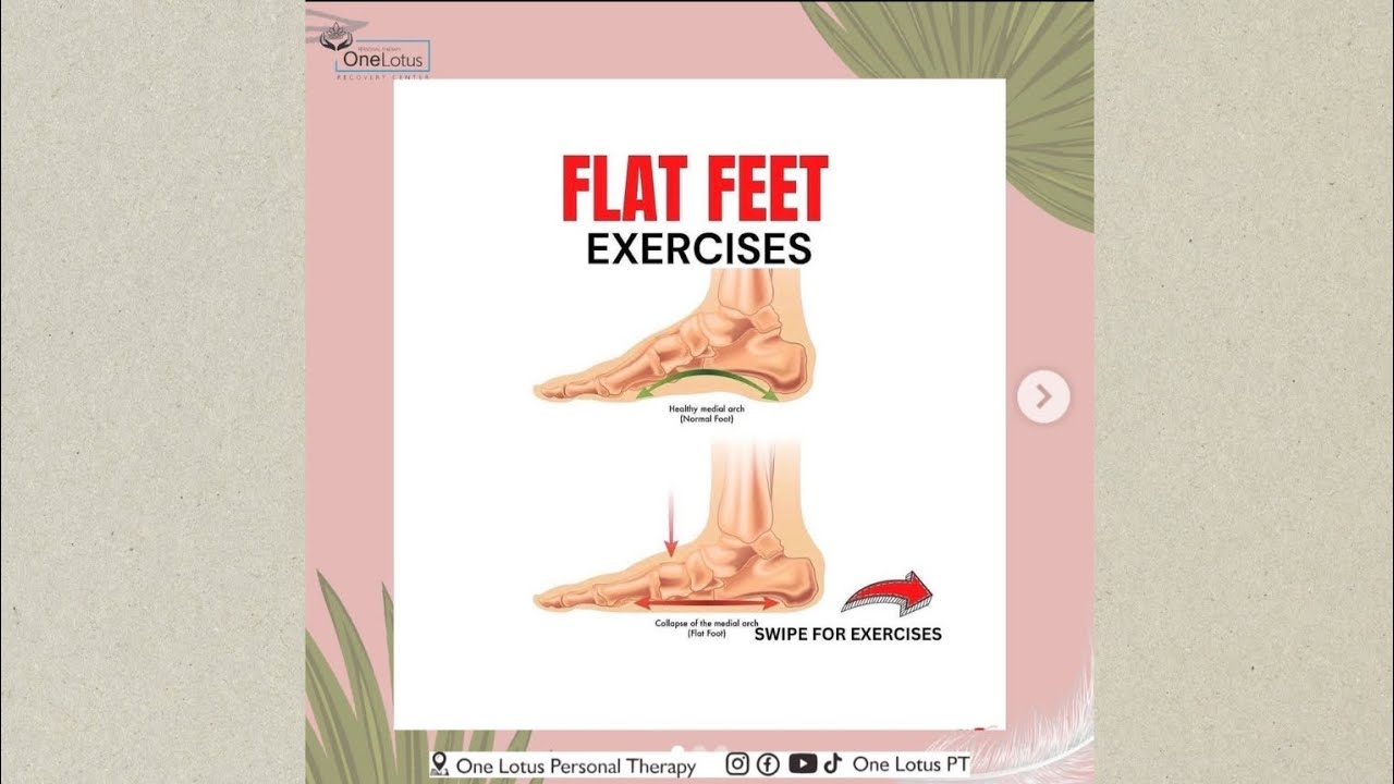 Anda Terkena Flat Foot / Kaki Rata⁉️ Lakukan Gerakan ini Untuk ...