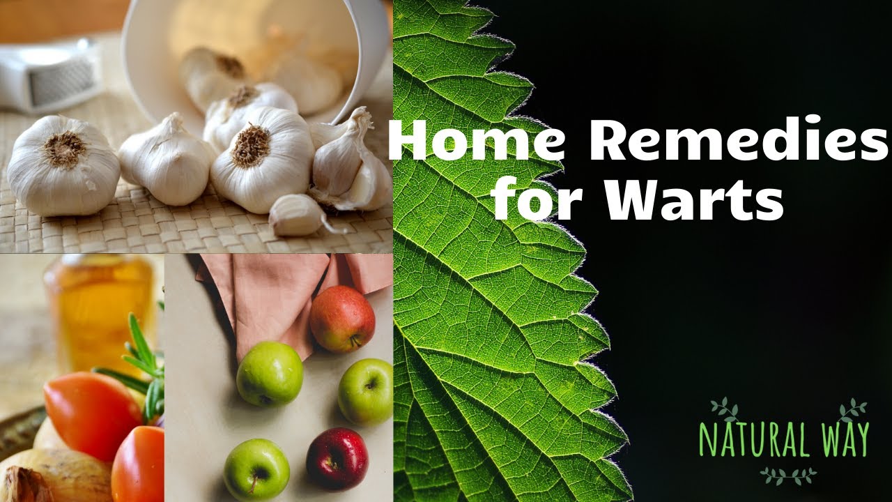Home Remedies for Warts - YouTube