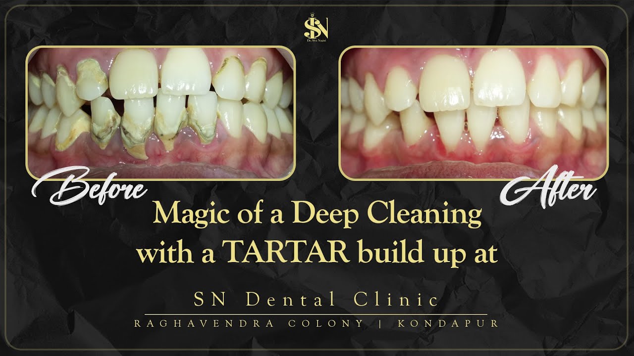 Deep cleaning of a tartar build up at sn dental clinic | Dr.sivanagini ...