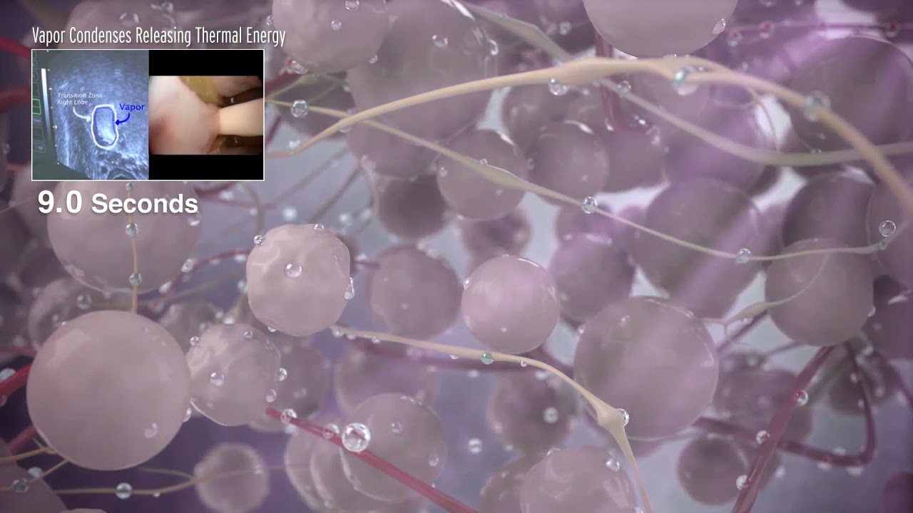 Rezum 3D Procedure Animation Patient Video - YouTube