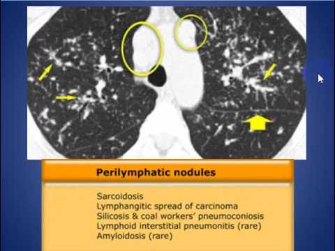 Radiology Rounds 15 Nodular Pattern of Secondary Pulmonary Lobule - YouTube