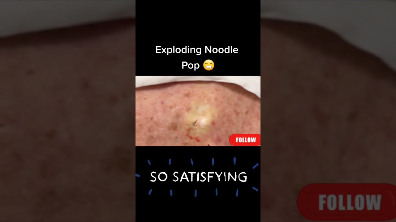 Pimple Popping 2021 - Blackheads & Whiteheads #29 - YouTube
