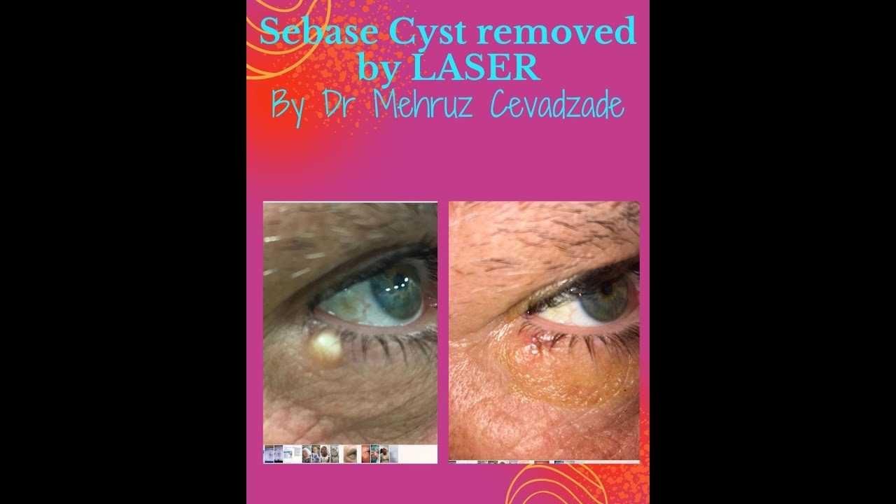 Fat Cyst Removal with Plasma Technique No skin scar sign /Alt kapakta ...