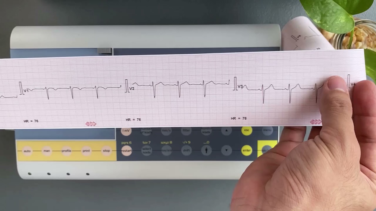 BTL ECG machine SD3 training video - YouTube