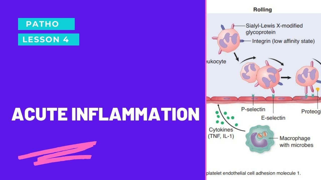Inflammation pathology - Acute inflammation, Robbins Competency based ...