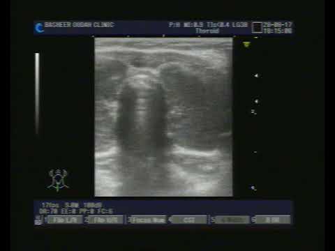 ultrasound of hashimoto thyroiditis - YouTube