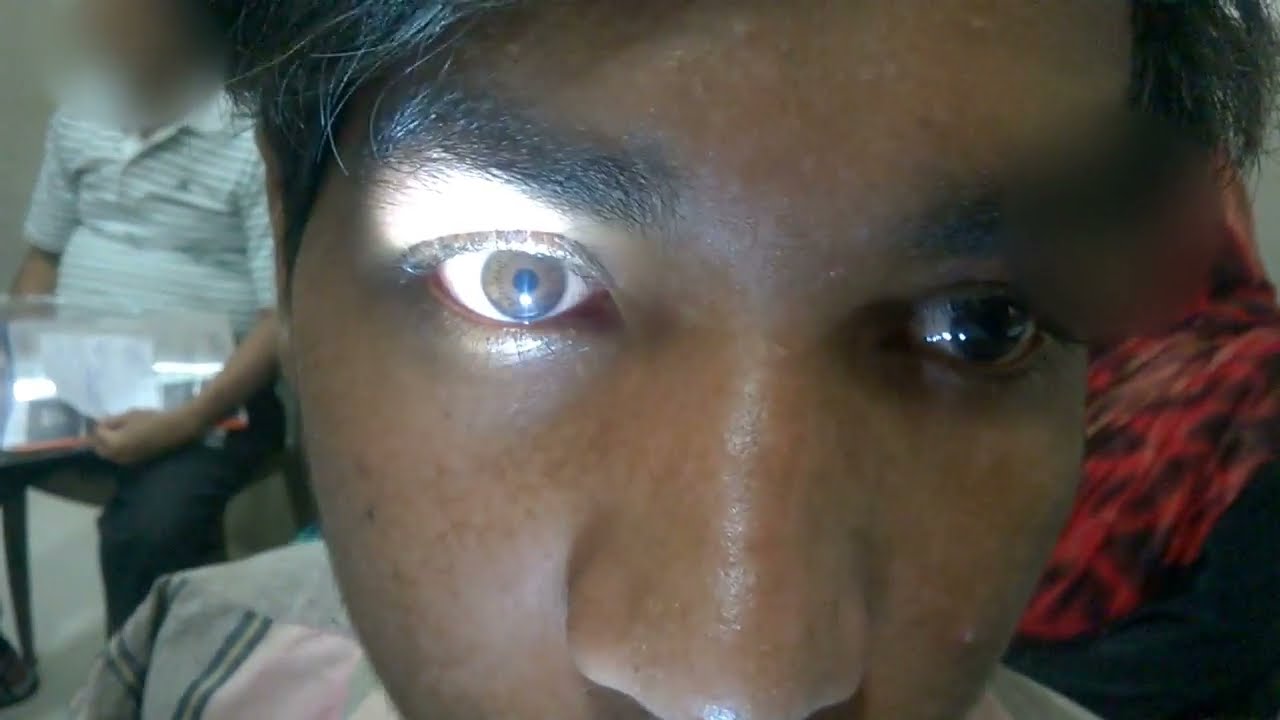 Afferent Pupillary Defect