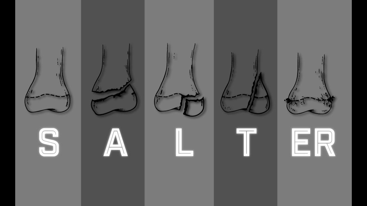 SALTER HARRIS CLASSIFICATION ORTHO REVISION VIDEO BY DR ZUBIN (AIR 8 ...