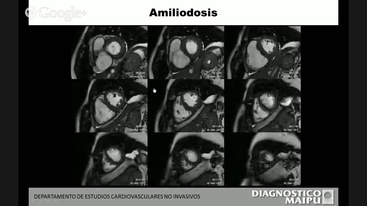 RMN CARDIACA; Dr Alejandro Deviggiano - YouTube