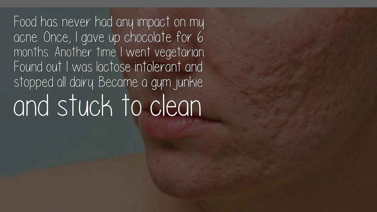 How Does The Food We Eat Affect Acne? - YouTube