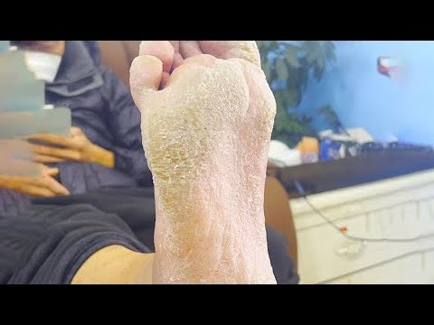 What should I do if the skin of the heel is thick and chapped - YouTube