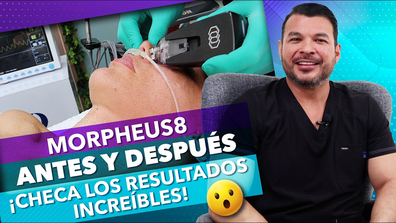 ¡Resultados increíbles con Morpheus8! | ANTES Y DESPUÉS | Dr. Romeo ...