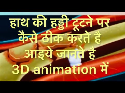Hand bone Repair in 3D animation! हाथ की हड्डी को कैसे ठीक करते है# ...
