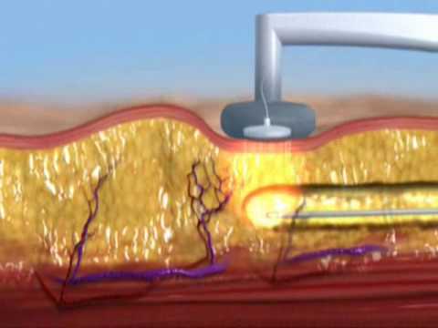 BodyTite - RFAL Radio Frequency Assisted Liposuction at the Northern ...