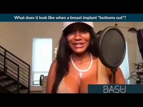 What does it look like when a breast implant “bottoms out”?