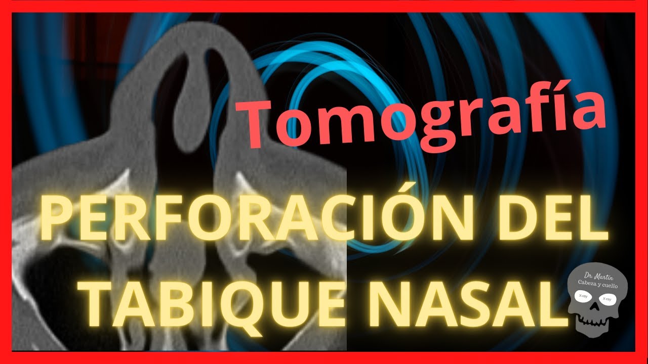 PERFORACIÓN del SEPTUM NASAL [Tomografía]👃 - YouTube