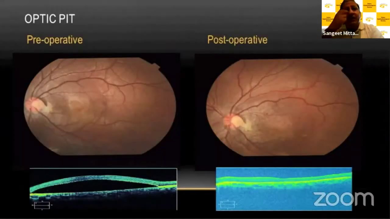 The Bull's Eye - Webinar on Macular Disorders by Jaipur ...