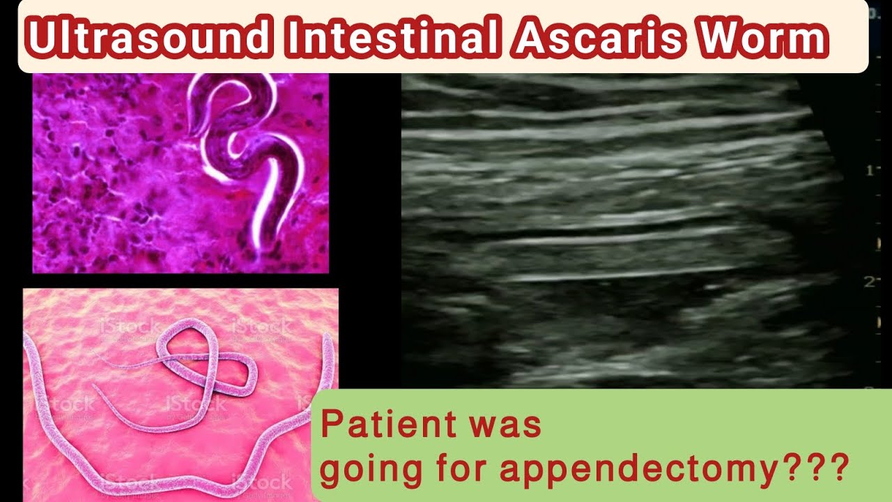 Ultrasound Intestinal Ascariasis , Ascaris Worm GIT ( Intestine ...