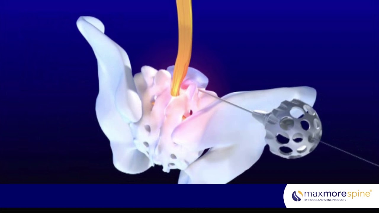 MaxMoreSpine Transforaminal Endoscopy Animation V3 - YouTube