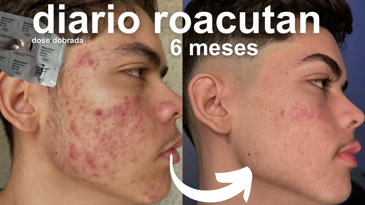 DIÁRIO DE ROACUTAN 6° MÊS DE TRATAMENTO! - YouTube
