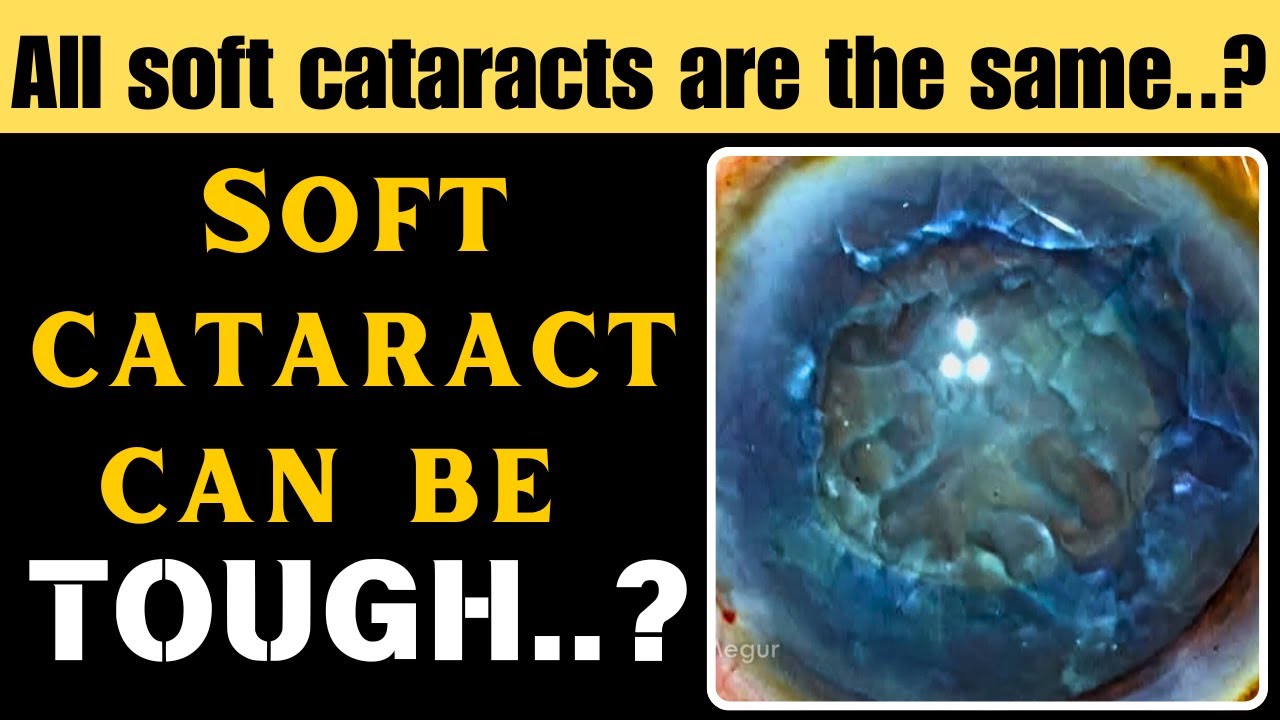 Soft cataract can be tough : Secrets of soft cataract management - Dr ...