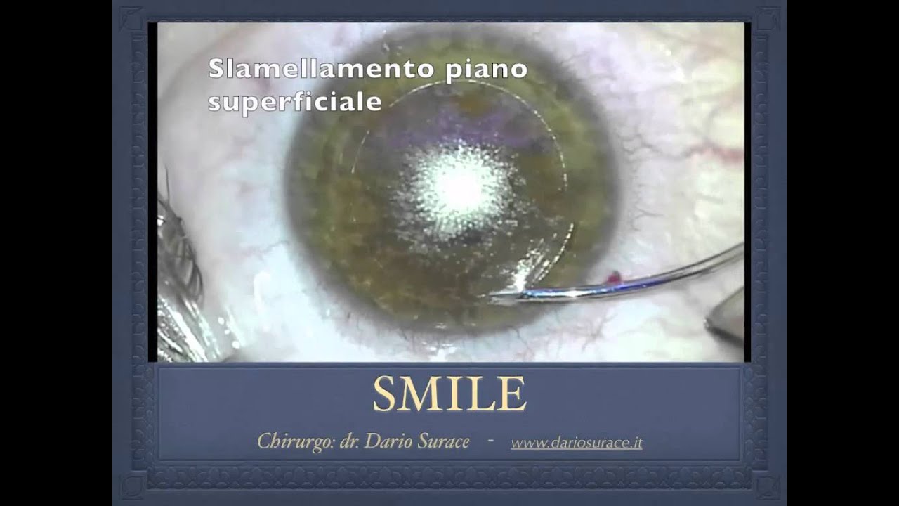 ReLEx® SMILE: come correggere difetti refrattivi. Dr. Dario Surace ...