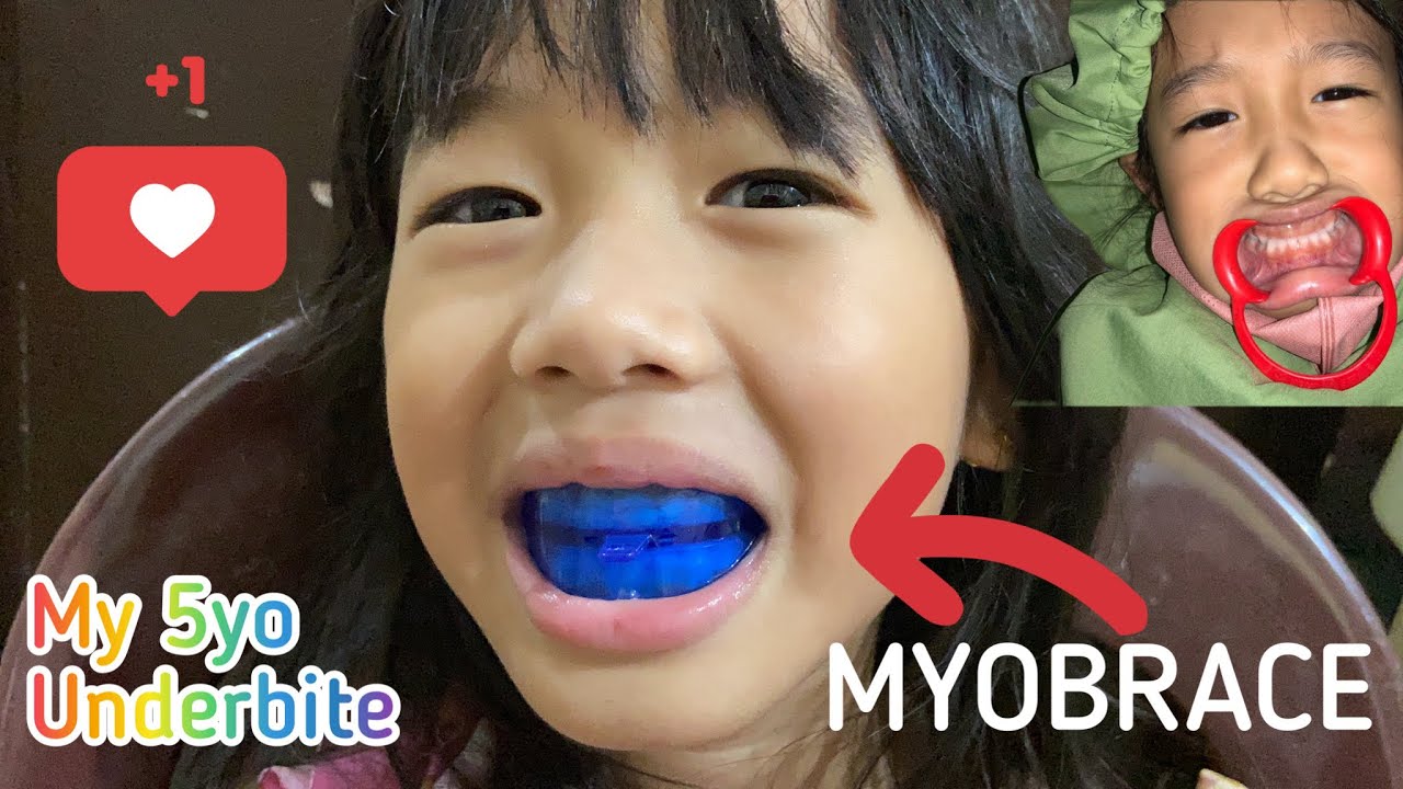 Fixing my 5yo child’s underbite | Child Myobrace | Davao Edition - YouTube
