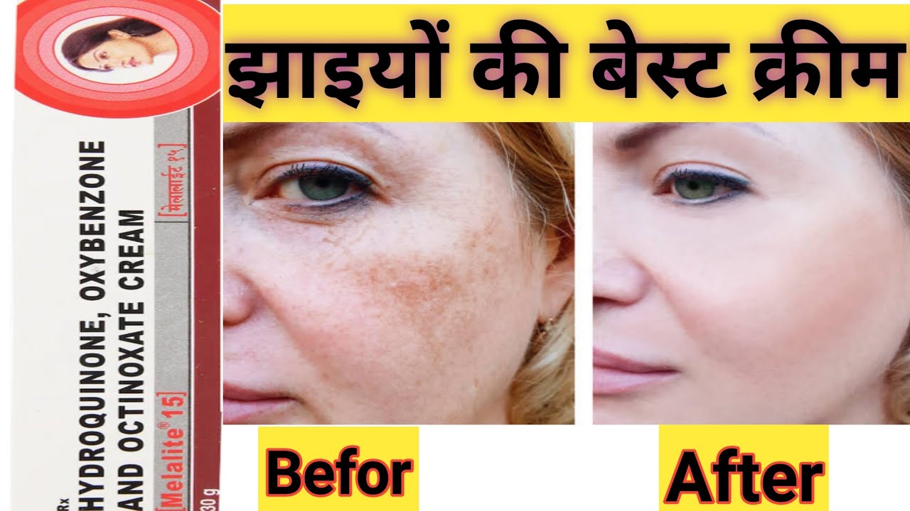 Pigmentation Cream | Melatite 15 cream | jhaiyo ki best Cream - YouTube