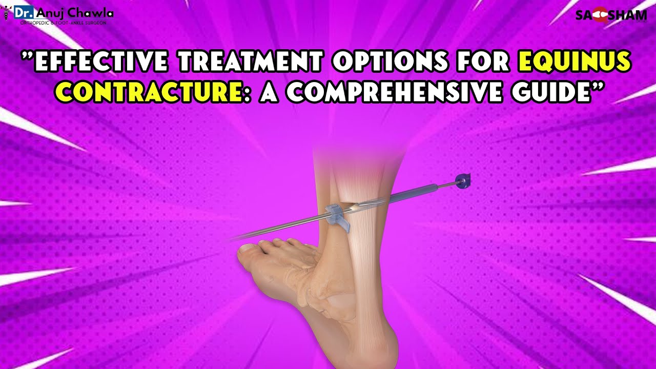 Effective Treatment Options for Equinus Contracture | Expert Advice by ...