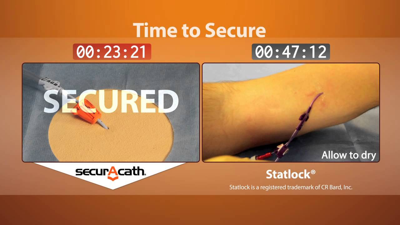 SecurAcath vs Statlock securement time - YouTube