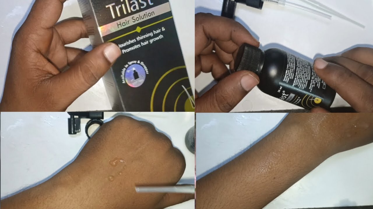Trilast hair solution uses in hindi price application side-effects ...