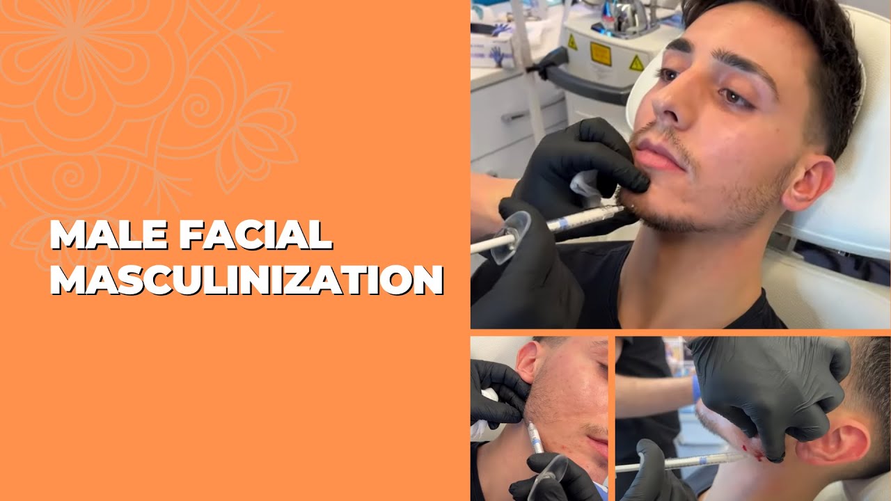 MALE FACIAL MASCULINIZATION WITH DERMAL FILLERS | Dr. Jason Emer - YouTube