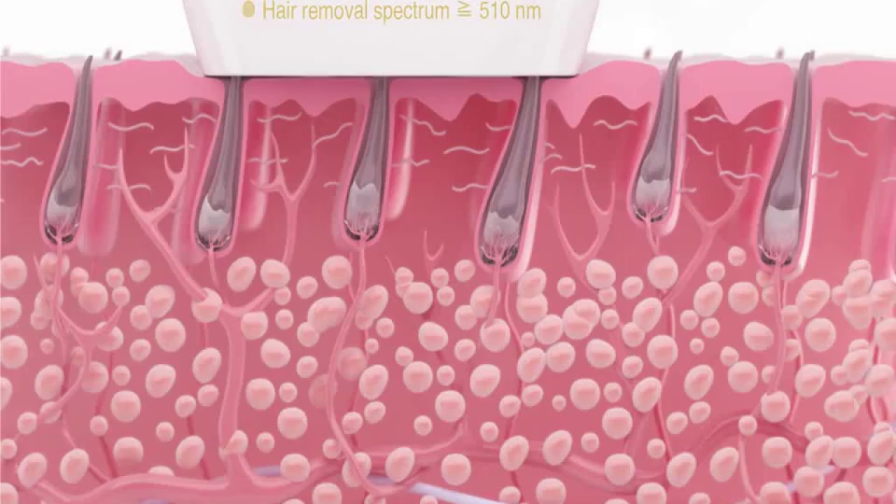 iMooie Beauty Hair removal steps - YouTube