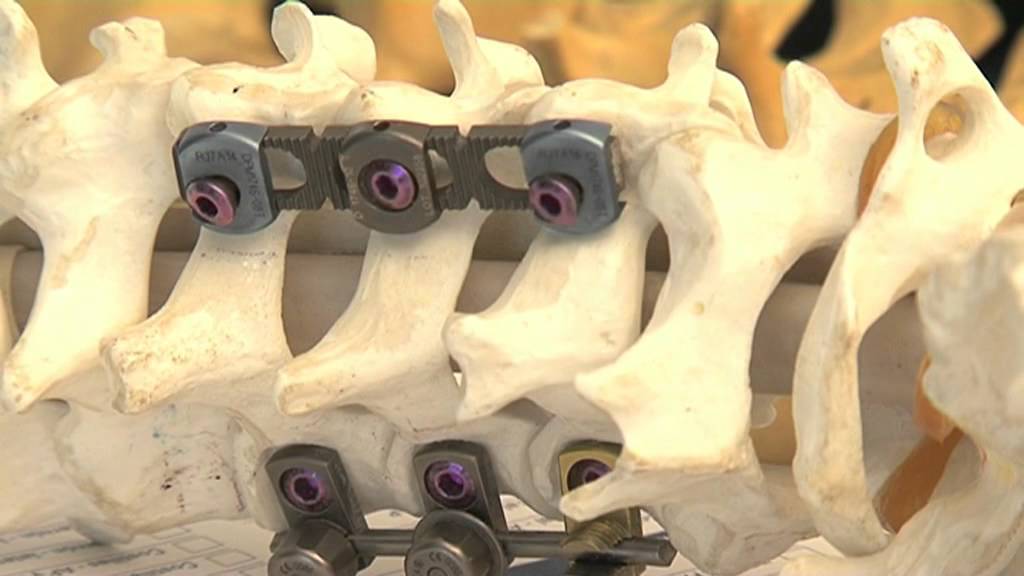 Cirugía de la columna vertebral - Dr. Ramón Florensa - YouTube