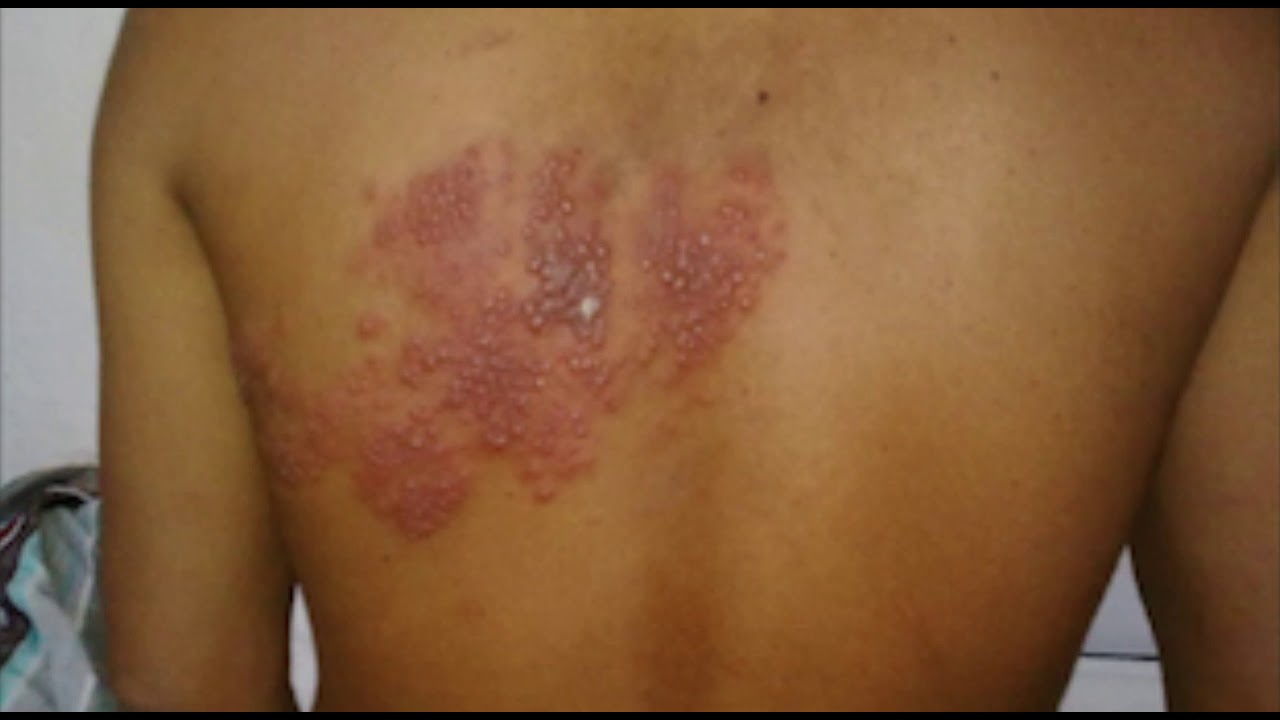 herpes simplex - YouTube