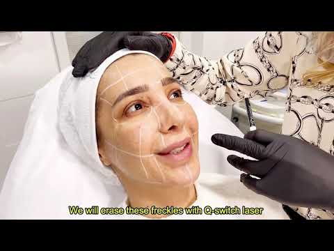 Q Switched Laser ✨