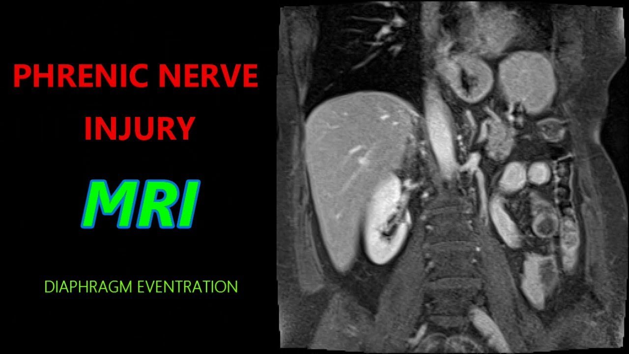 PHRENIC NERVE INJURY MRI - Paralyzed Diaphragm - Eventration - YouTube