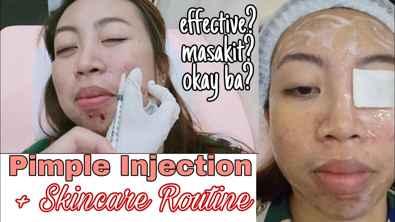 PIMPLE INJECTION, effective ba? + Skincare Routine | Valentines Day ...