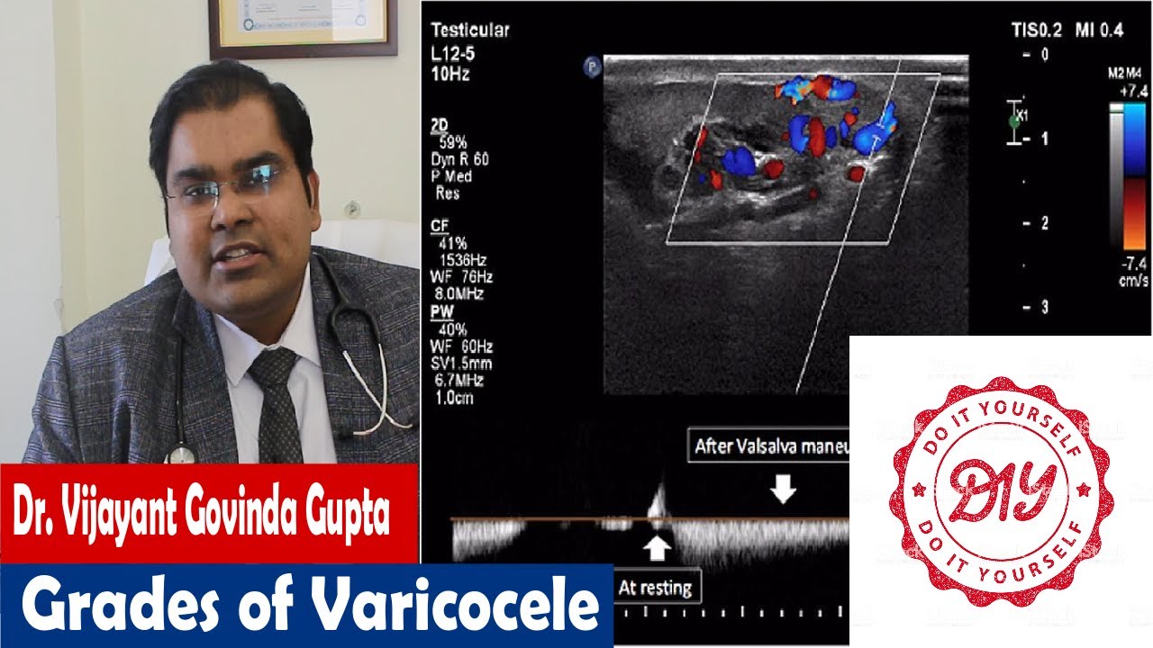 Easy do it yourself Grading of Varicocele | Understand your Varicocele ...