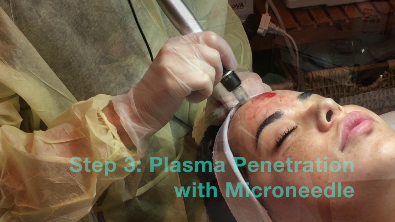 The Plasma Facial at Novopelle Med Spa Austin Dallas Houston - YouTube
