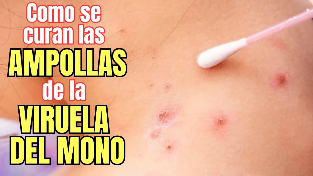 como-curar-las-ampollas-en-la-piel-de-la-viruela-del-mono-youtube