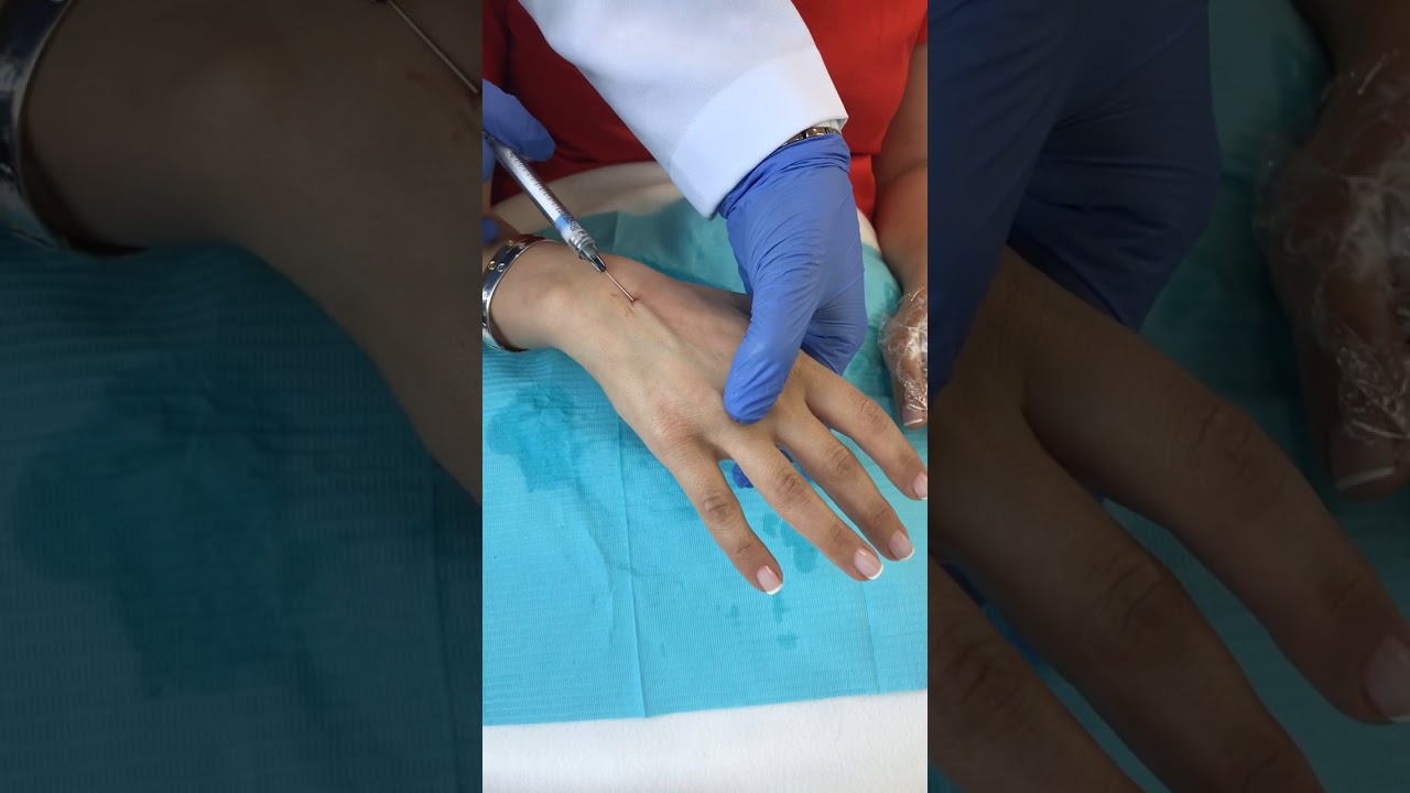 Radiesse. Filler for hand rejuvenation - YouTube