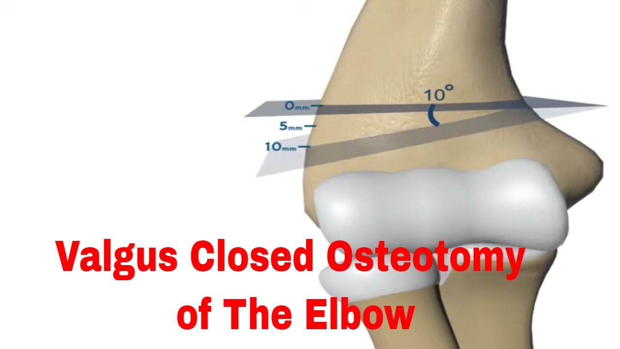 Valgus Closed Osteotomy of the Elbow: A Comprehensive Guide - YouTube