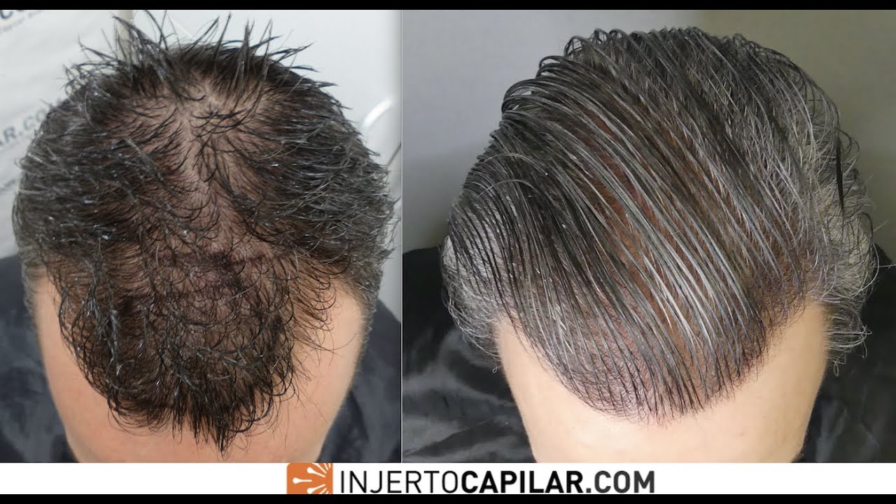 2001FUE Grafts. Frontal-Temporal peaks restoration. 5 years outcome ...