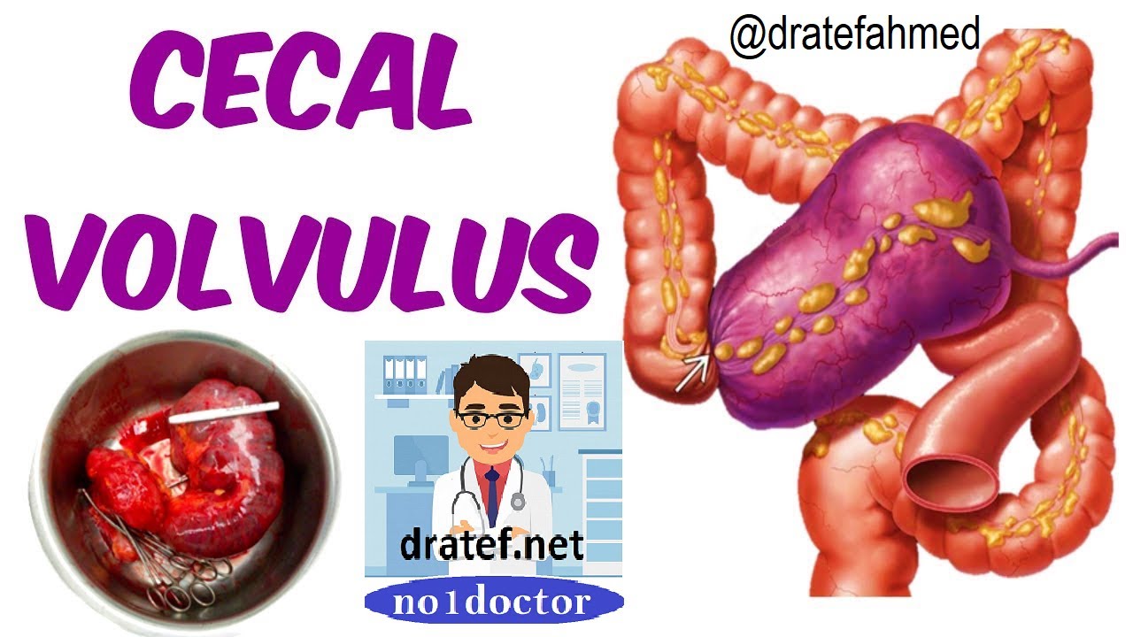 Cecal Volvulus / Causes / Pathology / Symptoms / Diagnosis / Treatment ...