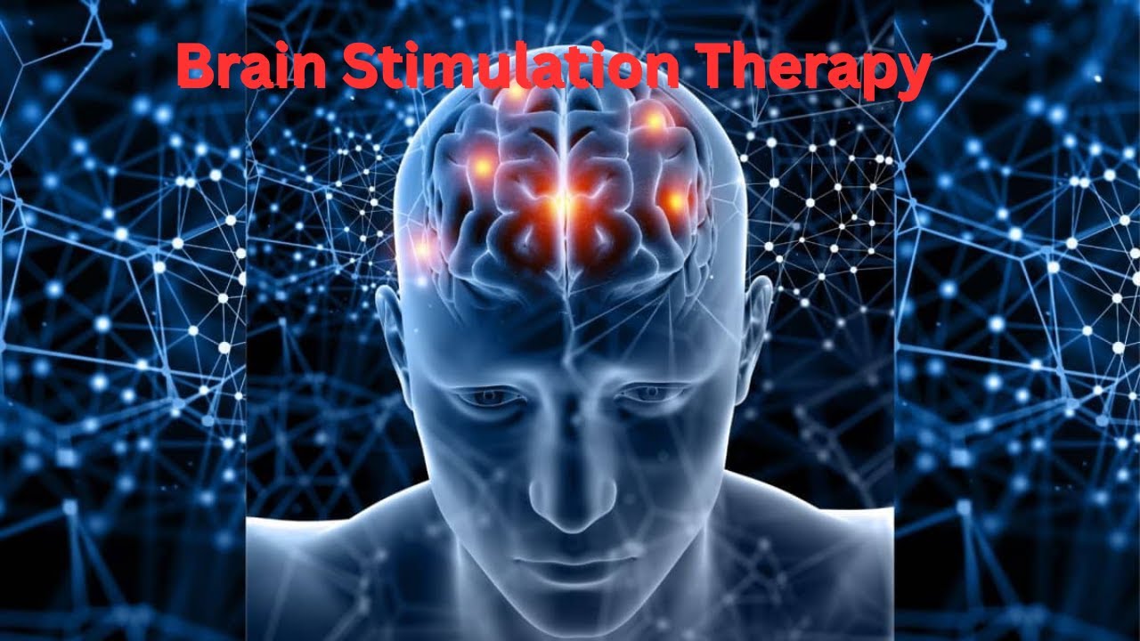 Brain Stimulation Therapy, a game changer - YouTube