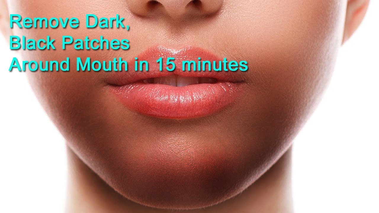 How To Remove Dark Black Patches Dark Spots Hyperpigmentation Around how-to-remove-dark-black-patches-dark-spots-hyperpigmentation-around